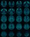 Autistic Brain vs. Neurotypical Brain: Surprising Perspectives ...